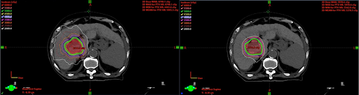 Liver and bile duct cancer - HPSP